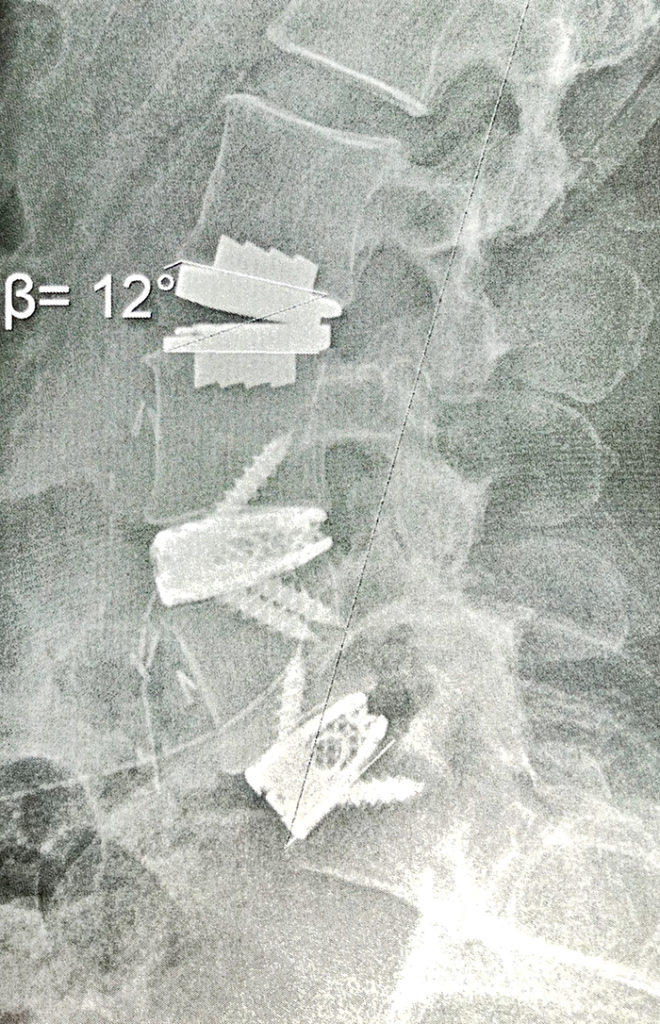 Le CCV réalise la première pose européenne du nouvel implant lombaire ...