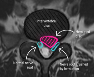 Minimally Invasive Herniated Disc Surgery - CCV Montpellier